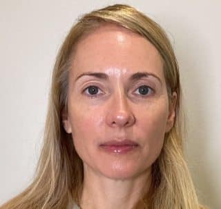 BroadBand Light (BBL) Facial & Skin Treatment | Elase