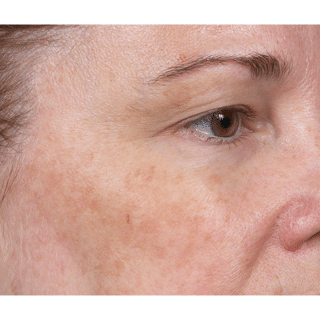 Clear and Brilliant Laser for Melasma and Scarring | Elise