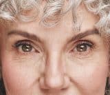 Sylfirm X RF Microneedling | Elase