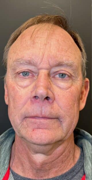 Sylfirm X RF Microneedling | Elase