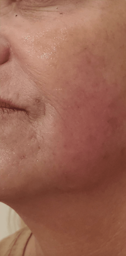 PDO NovaThreads Services & More | Elase Medical Spa