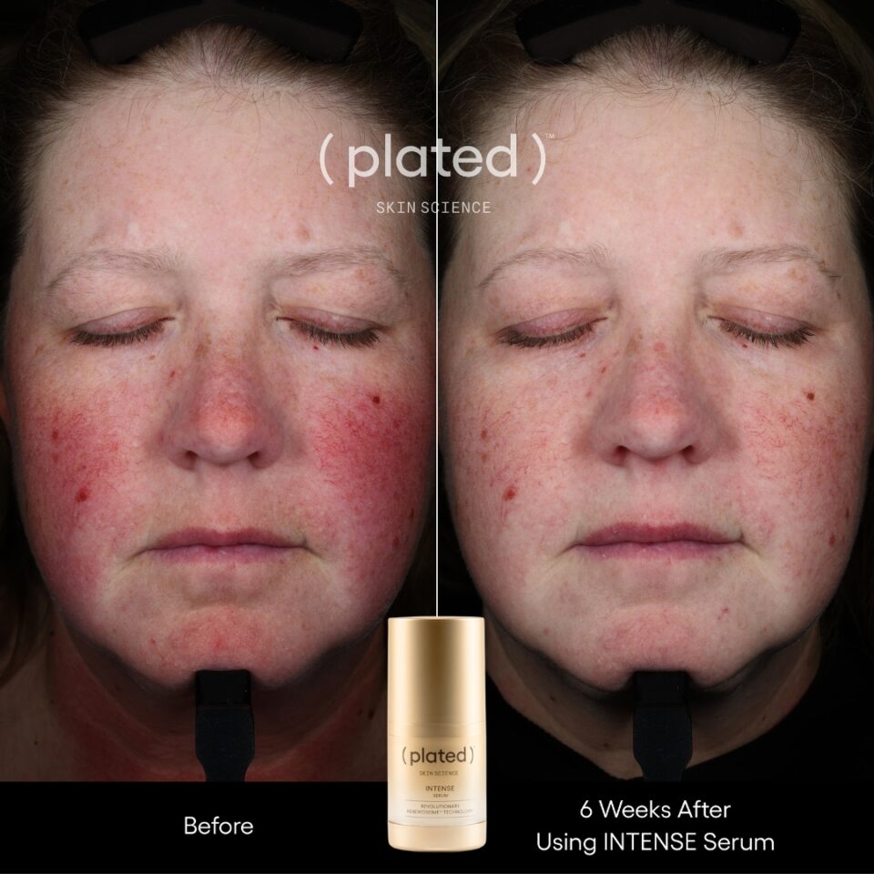 Plated Exosomes: The Future of Skincare is Here | Elase Med Spa