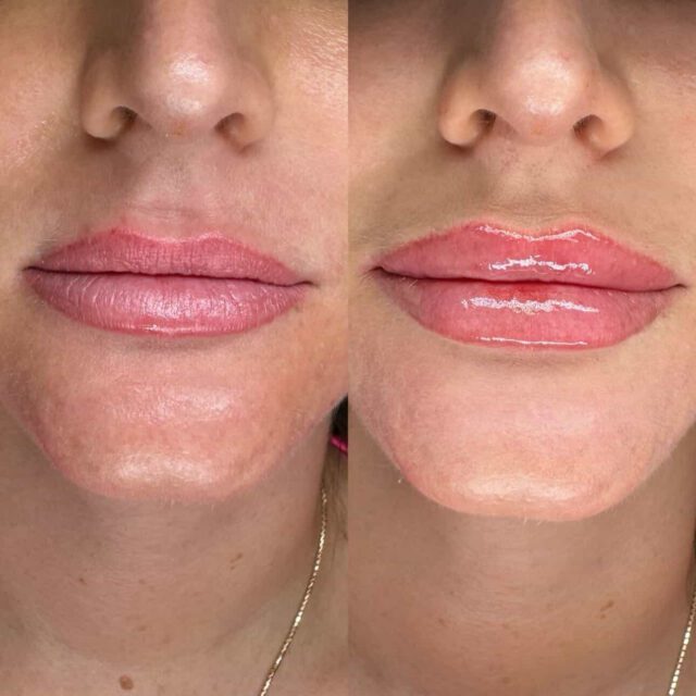 Dissolving Lip Filler: Day-by-Day Recovery Guide | Elase